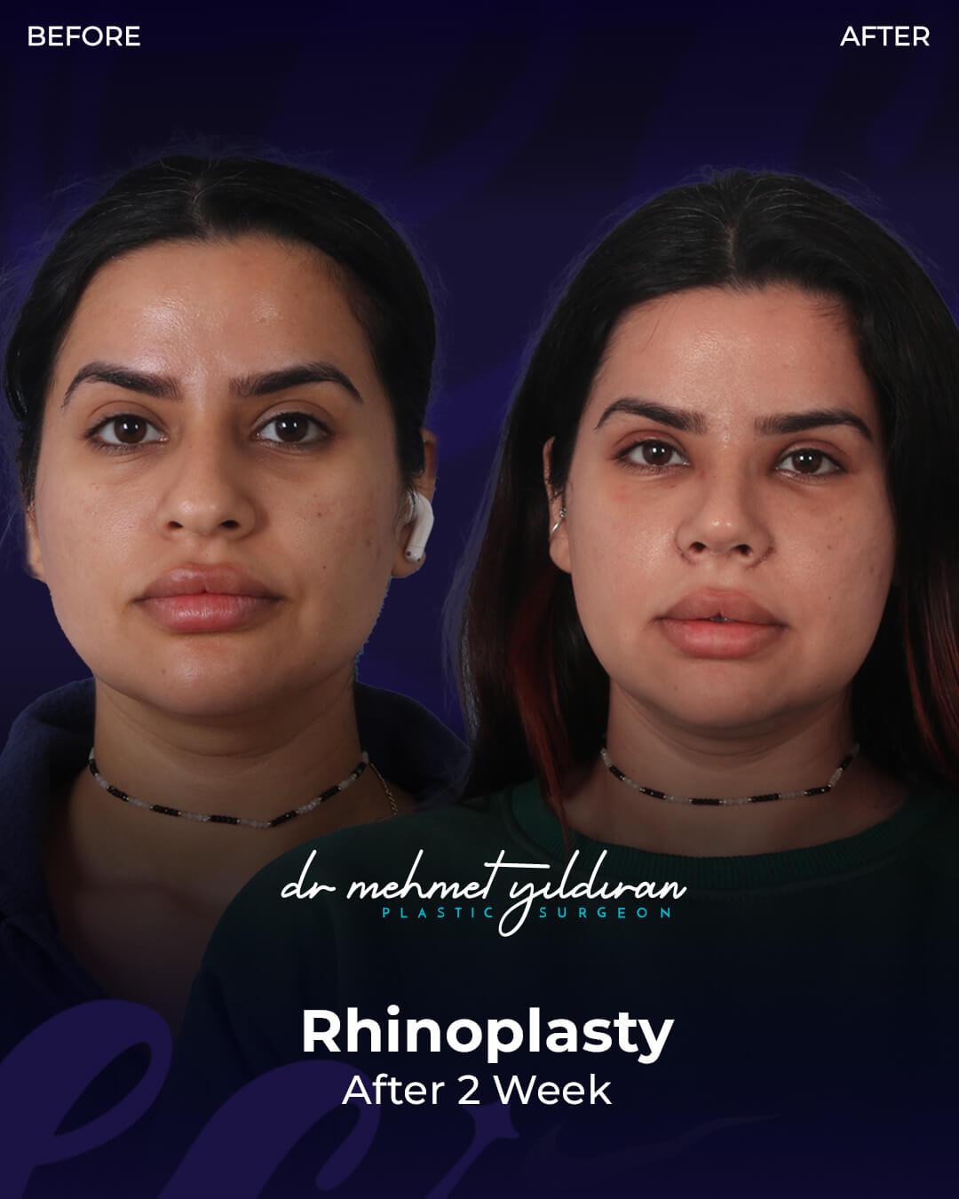 Nose Job – Dr. Mehmet Yıldıran
