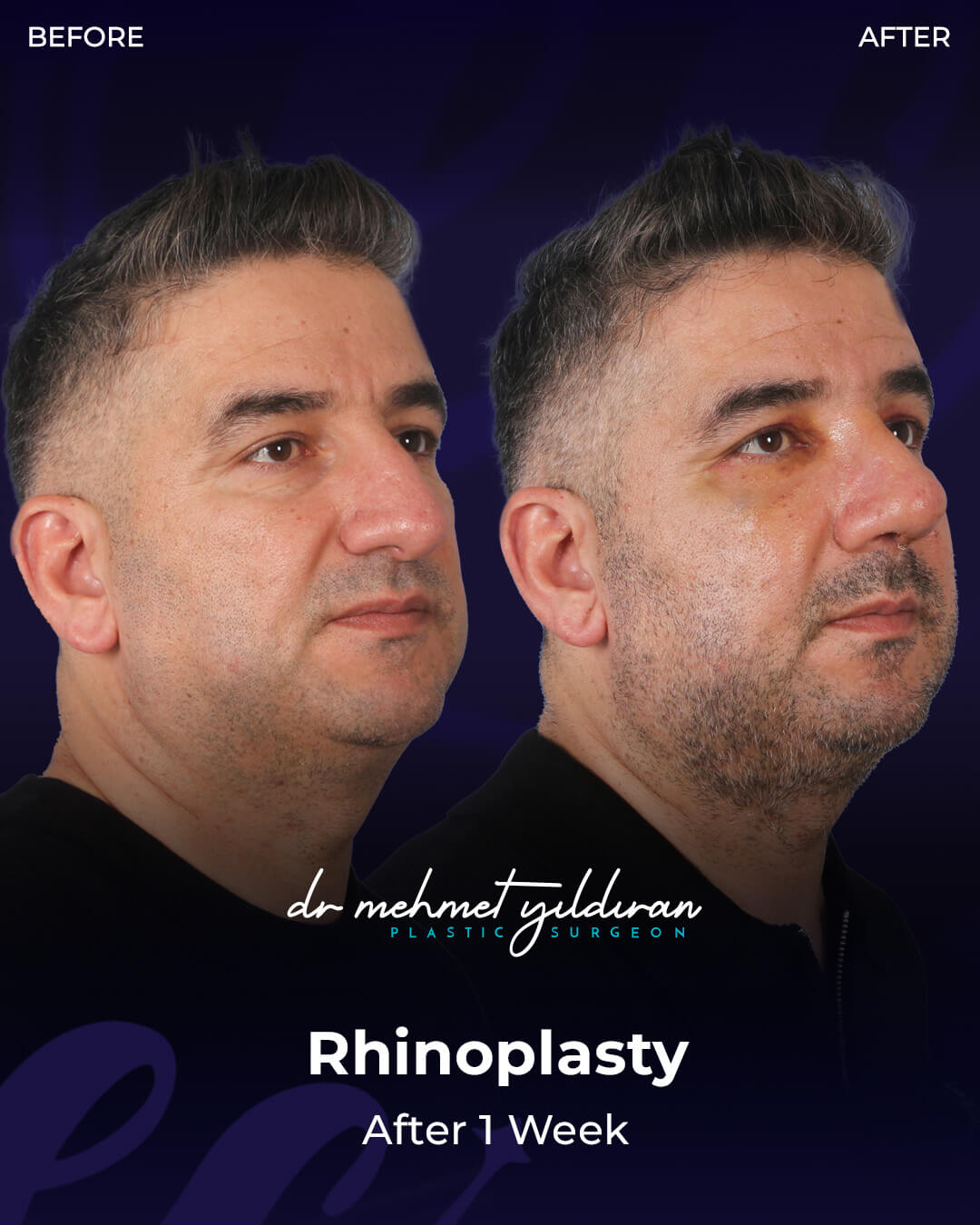 Nose Job – Dr. Mehmet Yıldıran