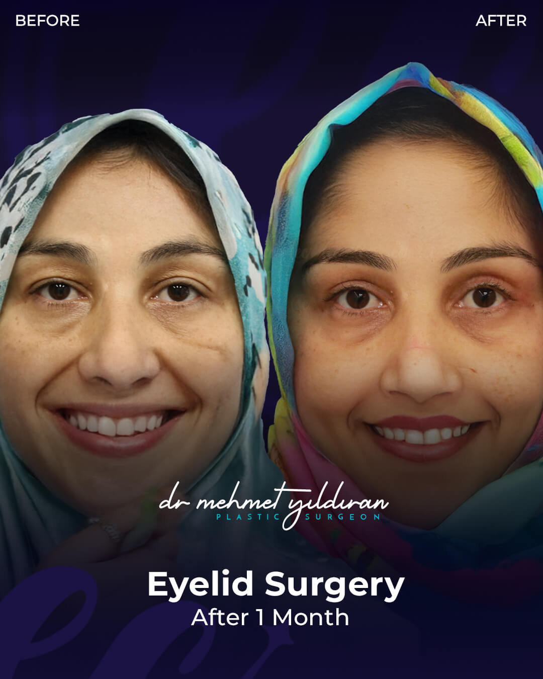 Eyelid Surgery: Refresh & Rejuvenate Your Eyes