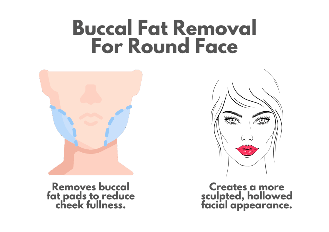 Buccal Fat Removal for Round Face – A Quick Guide – Dr. Mehmet Yıldıran