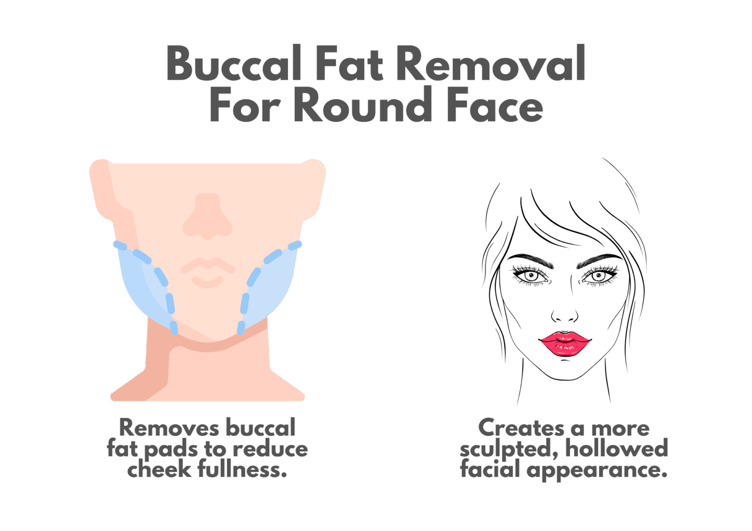 Buccal Fat Removal for Round Face – A Quick Guide – Dr. Mehmet Yıldıran