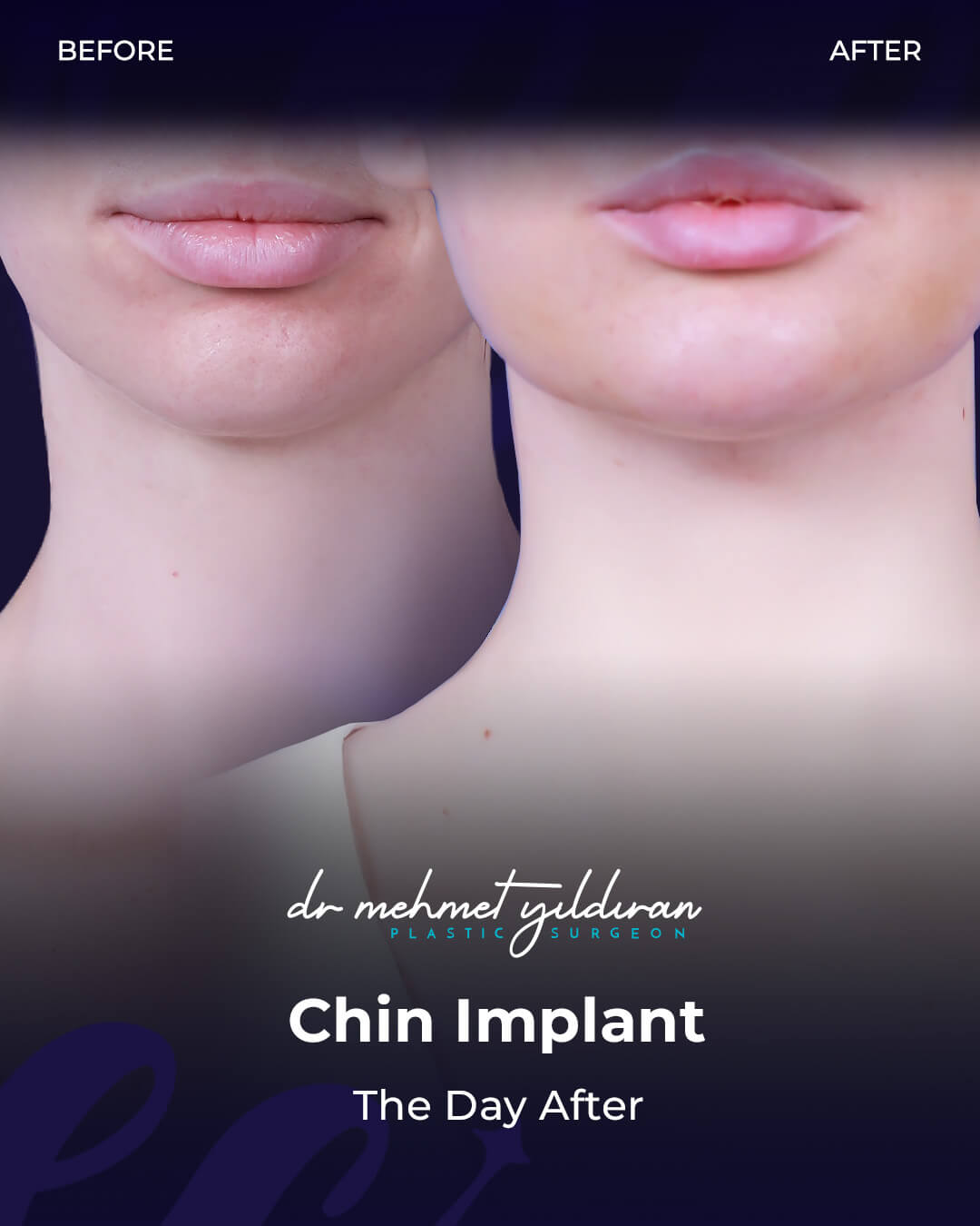 Chin Implant – Dr. Mehmet Yıldıran