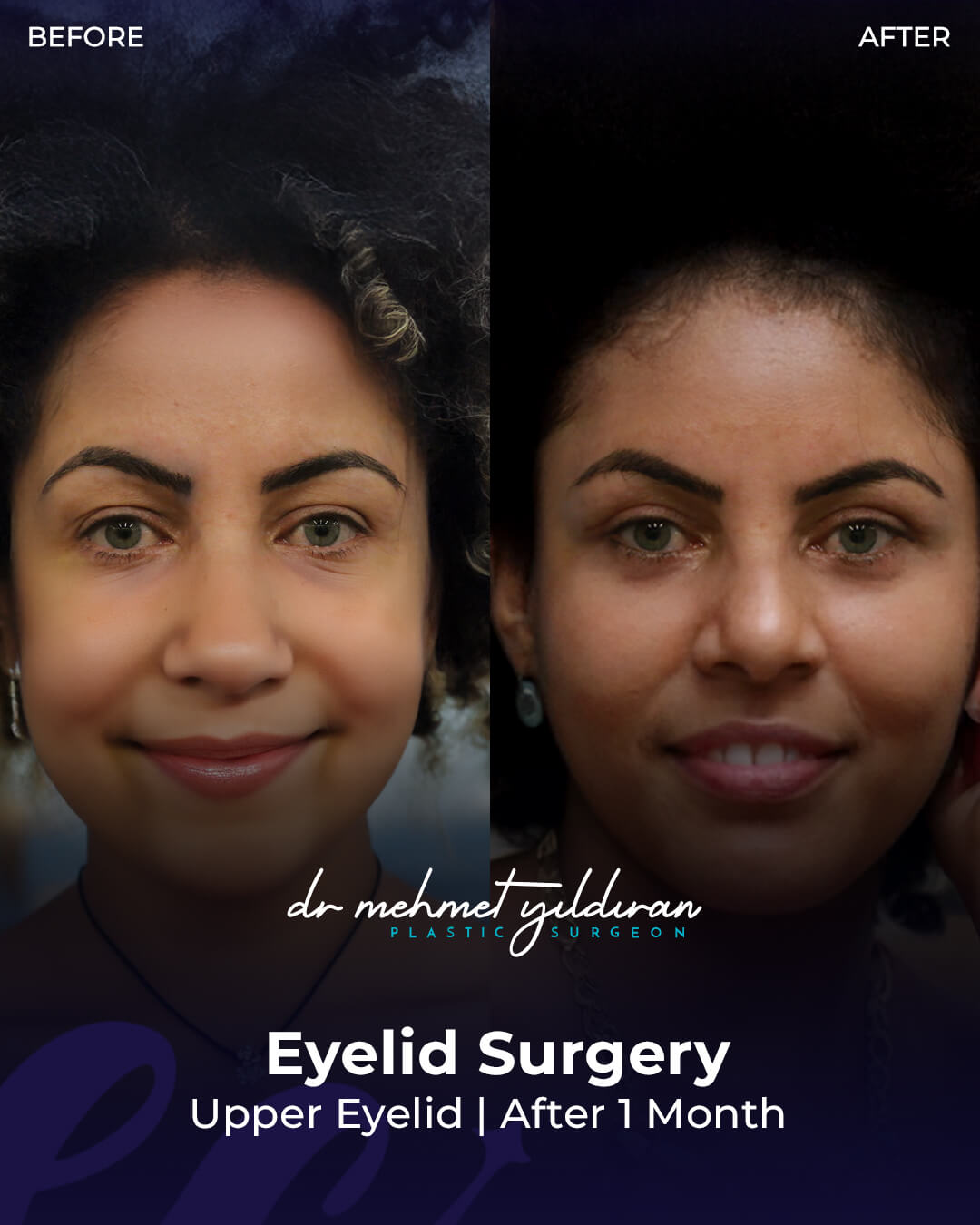 Eyelid Surgery: Refresh & Rejuvenate Your Eyes